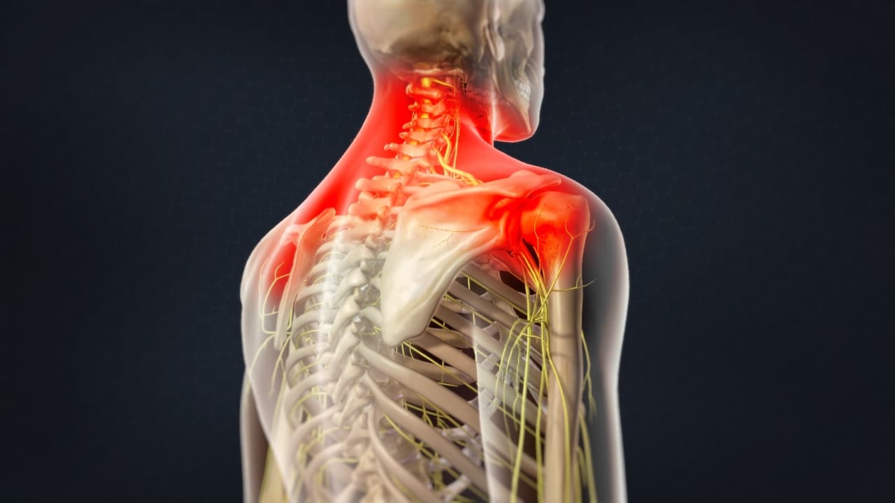 Cervical Trigger Point Infiltration - Relief for Neck Muscle Pain