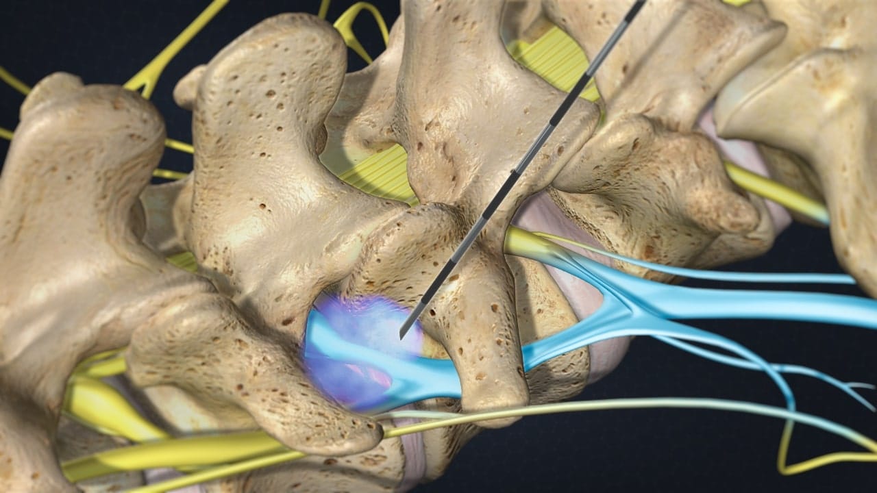 Therapeutic Spinal Injections - Effective Spine Treatment