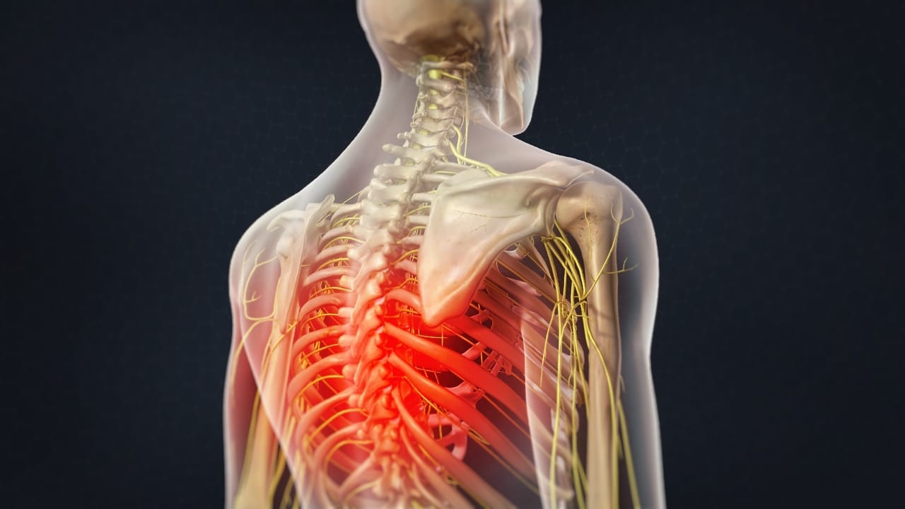 Thoracic Spinal Nerve Analgesia - Intercostal Neuralgia Treatment ...