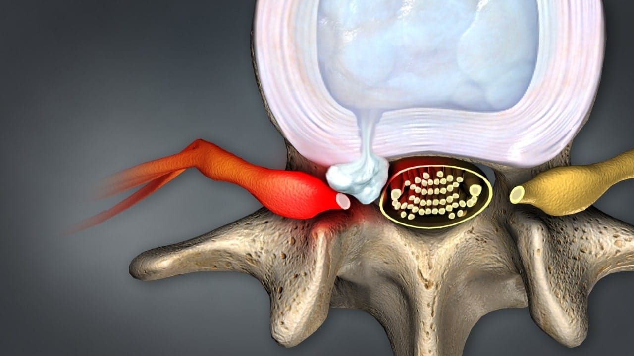 Spontaneous Regression of Herniated Disc: Causes & Treatment