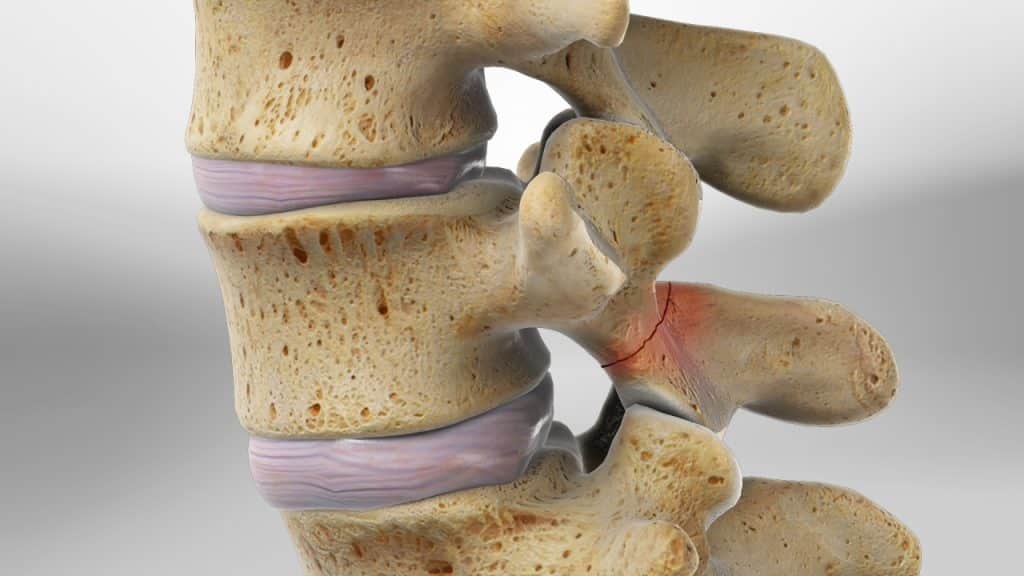 Spondylolisthesis Und Spondylolyse